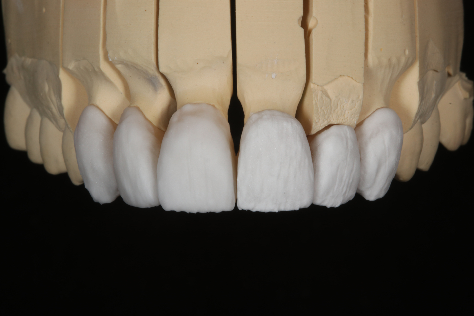 The zirconia dream team: Effect liquids and micro-layering